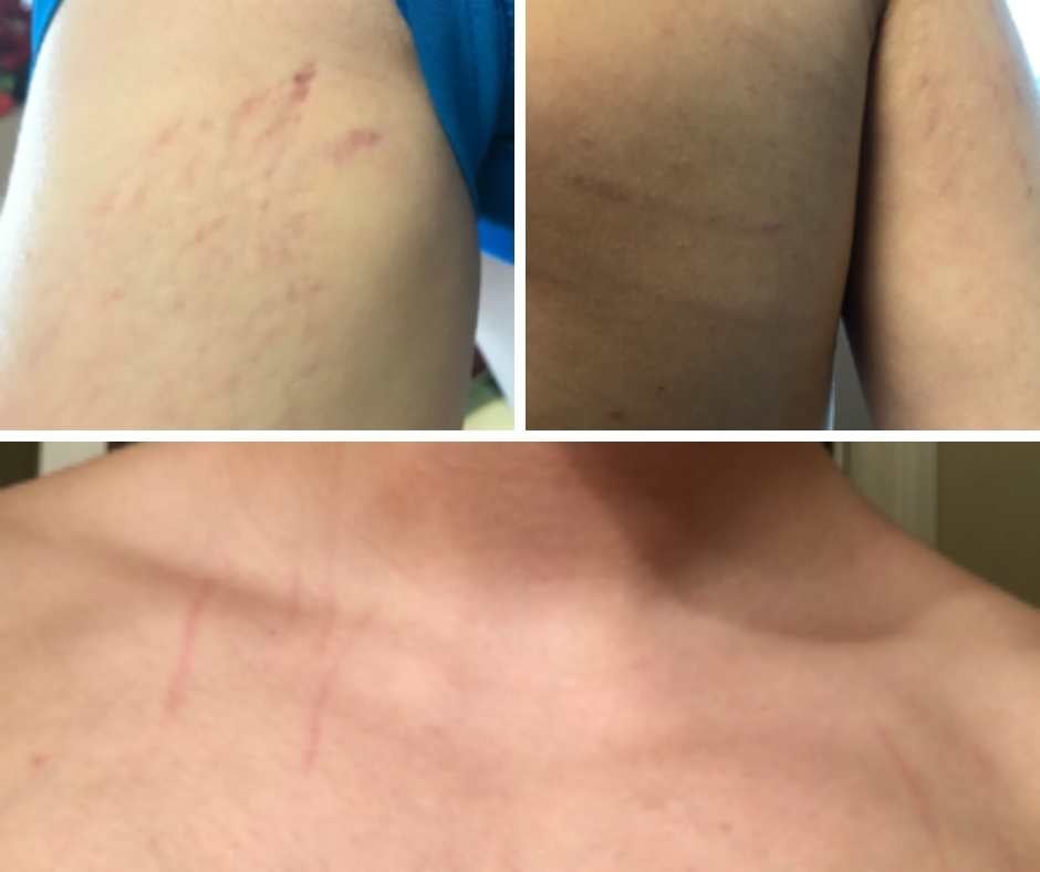 Bartonella - The Stealth Pathogen That Can Be “Seen” Without a Microscope