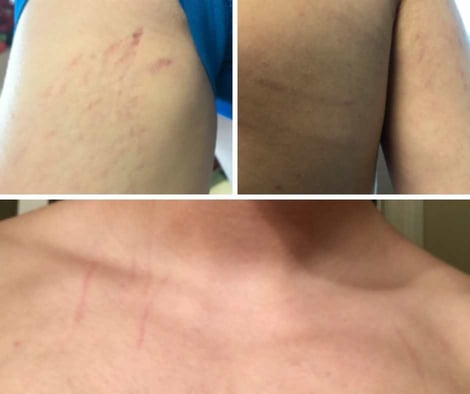 Bartonella - The Stealth Pathogen That Can Be “Seen” Without a Microscope